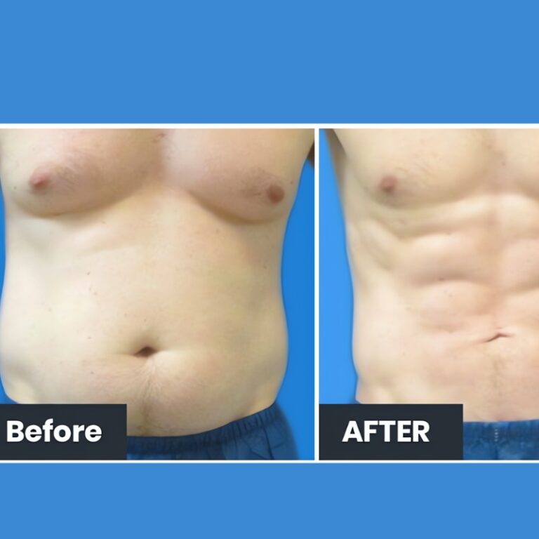 Sono Bello Laser Liposuction - Associates in Family Practice, P.C.